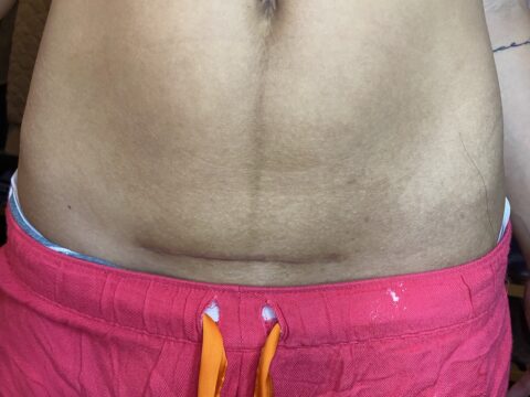 C Section Scar And Recovery Guide You Need | Lifting Motherhood