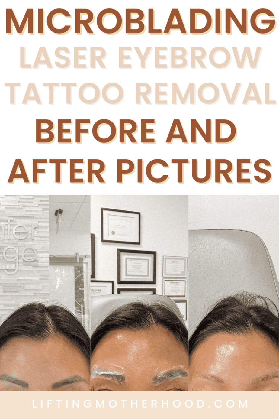 Microblading And Eyebrow Tattoo Removal Experience - Lifting Motherhood LLC